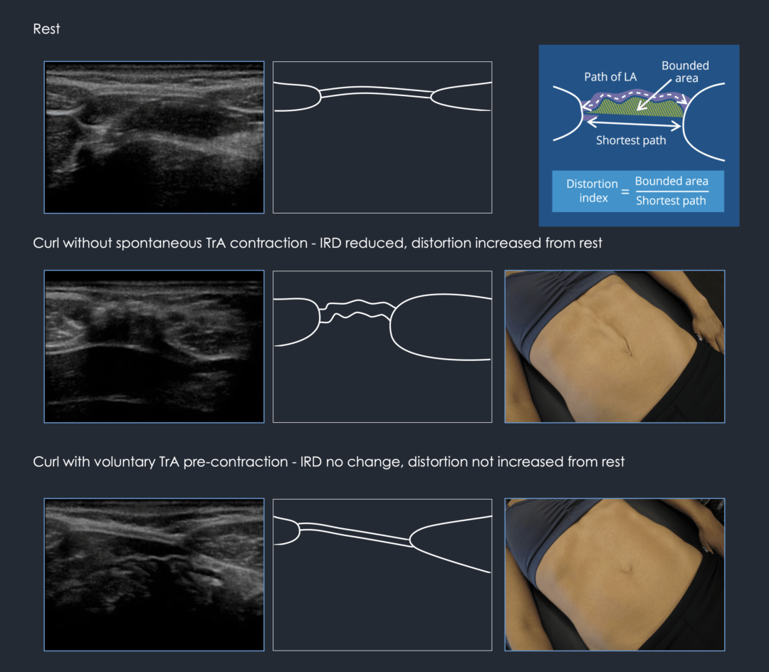 Diastasis Rectus Abdominis - Diane Lee & Associates Physiotherapy