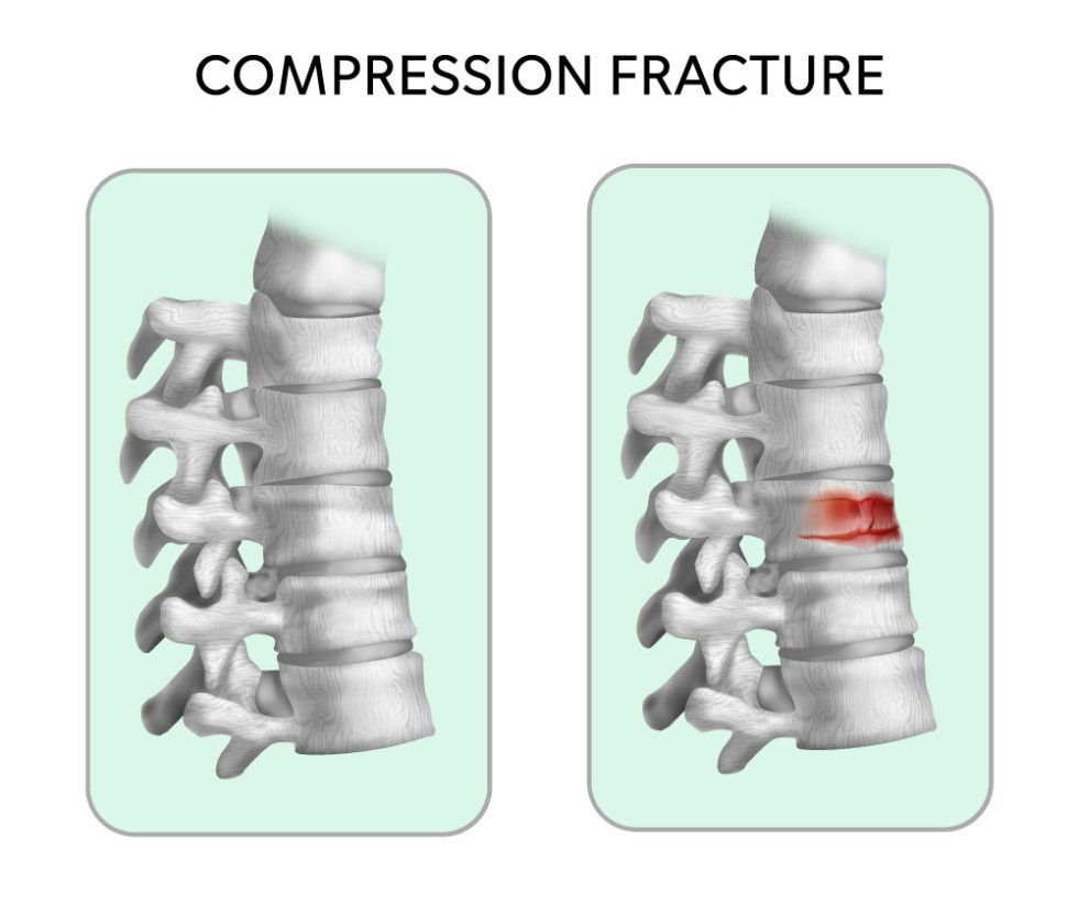 Pre & Post Spinal Surgery - Diane Lee & Associates Physiotherapy